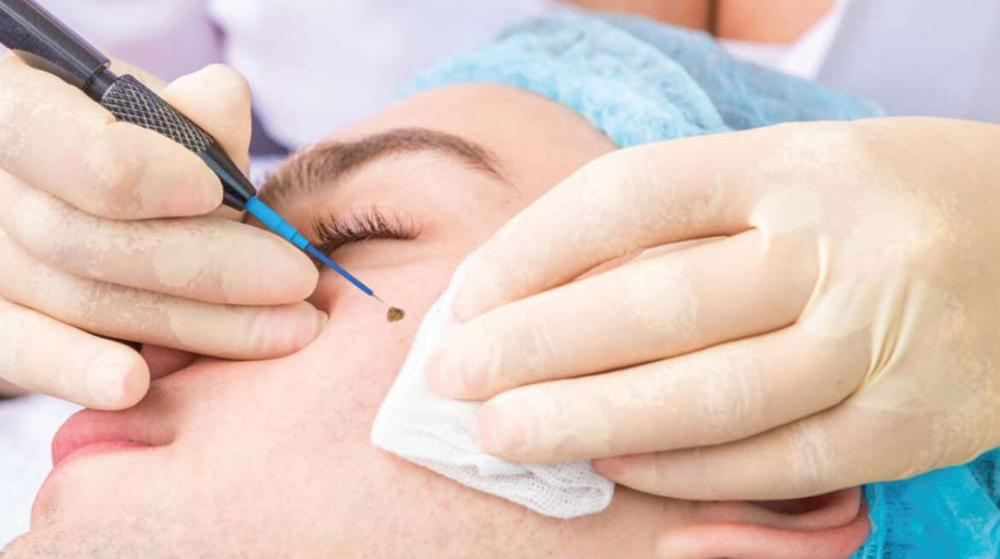 Electrocauterization Treatment for Skin Lesions - Medical Zone